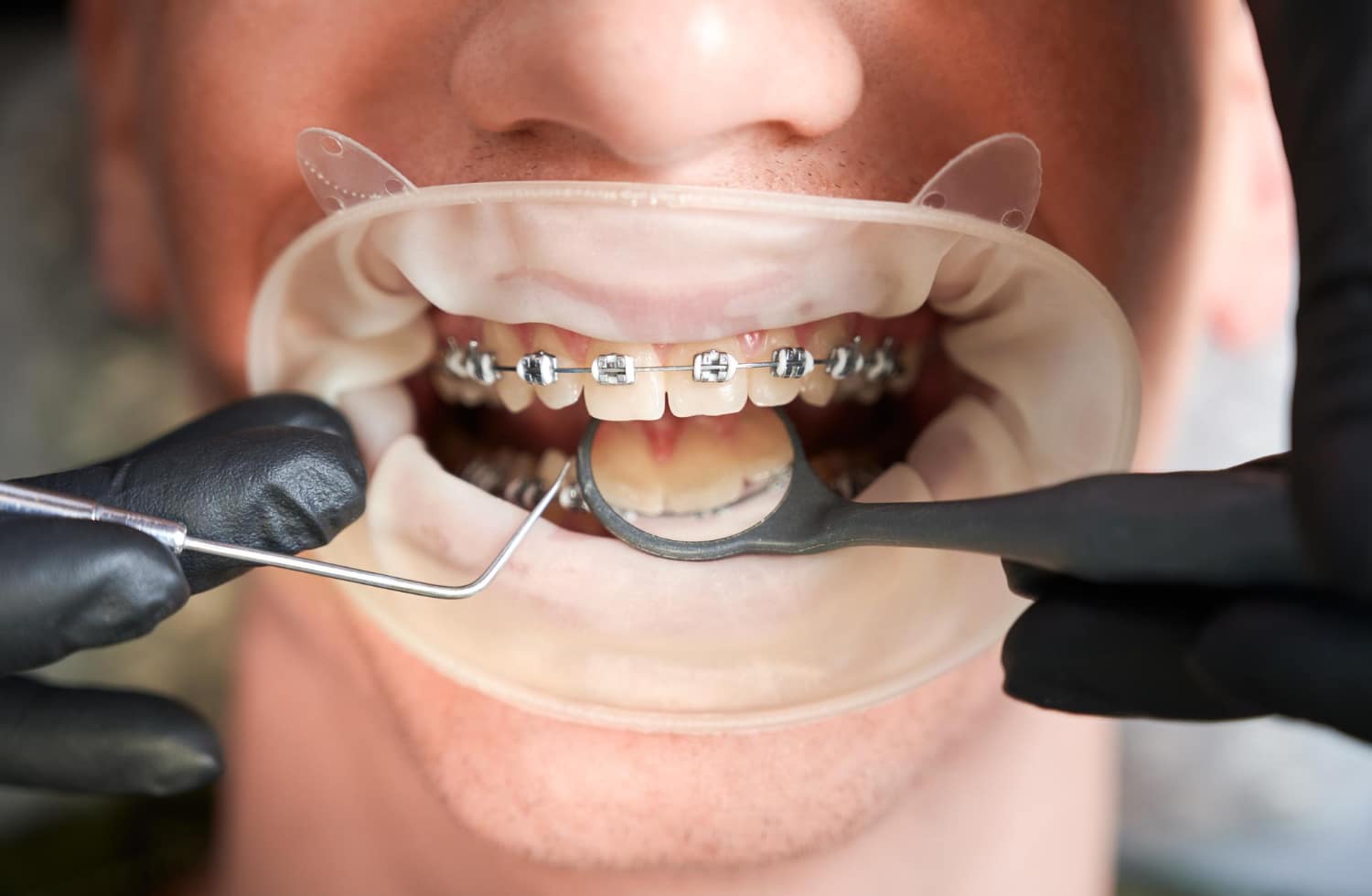 8 Health Benefits of Straight Teeth | Braces in Traverse City